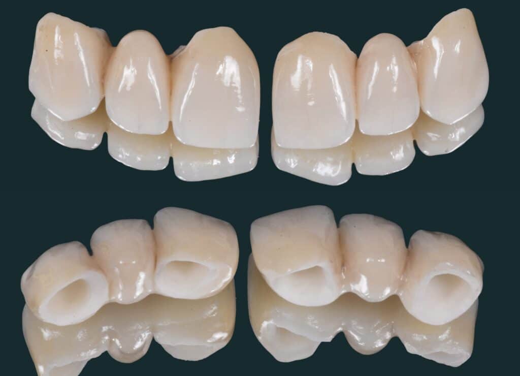 Bridges à Paris 16 | Cabinet dentaire | Dr Alexandre Sarfati