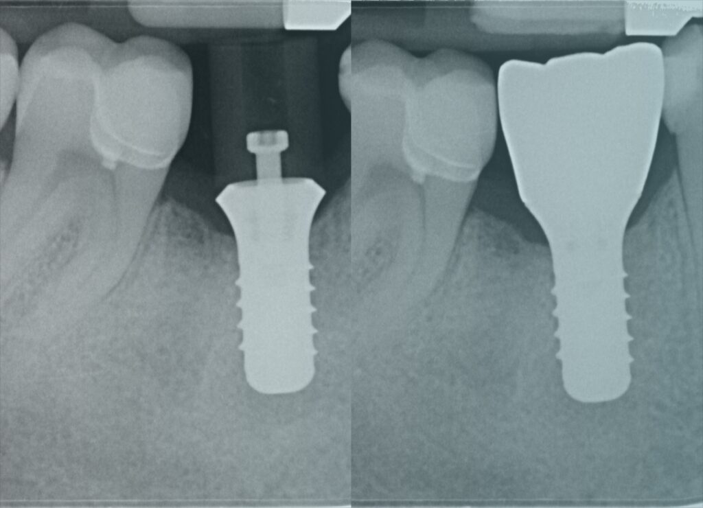 Implant dentaire | Cabinet dentaire | Dr Alexandre Sarfati | Paris 16