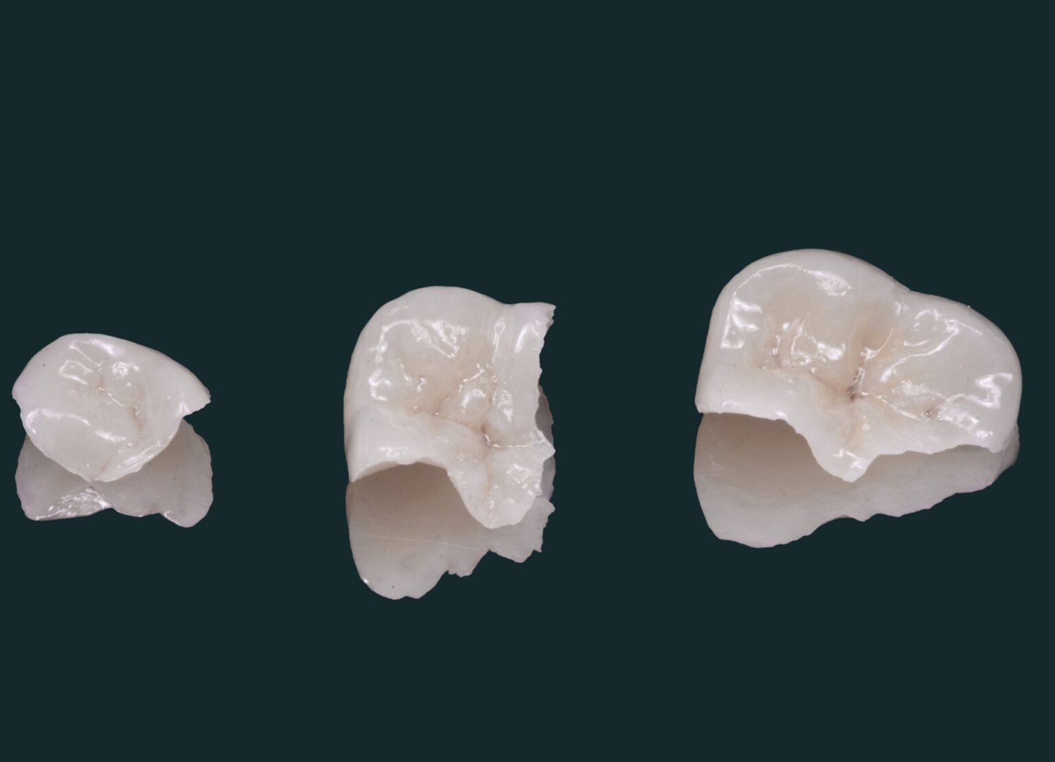 Inlays, Onlays, Overlays à Paris 16 | Cabinet dentaire | Dr A.Sarfati