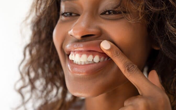 Comment se déroule une greffe de gencive et quelles sont les étapes de la cicatrisation ? | Dr ...