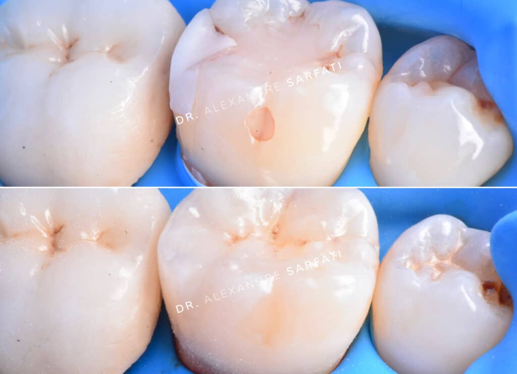 Inlays, Onlays, Overlays à Paris 16 | Cabinet dentaire | Dr A.Sarfati